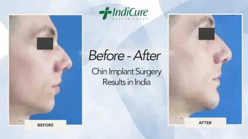 Chin Implant Surgery Abroad